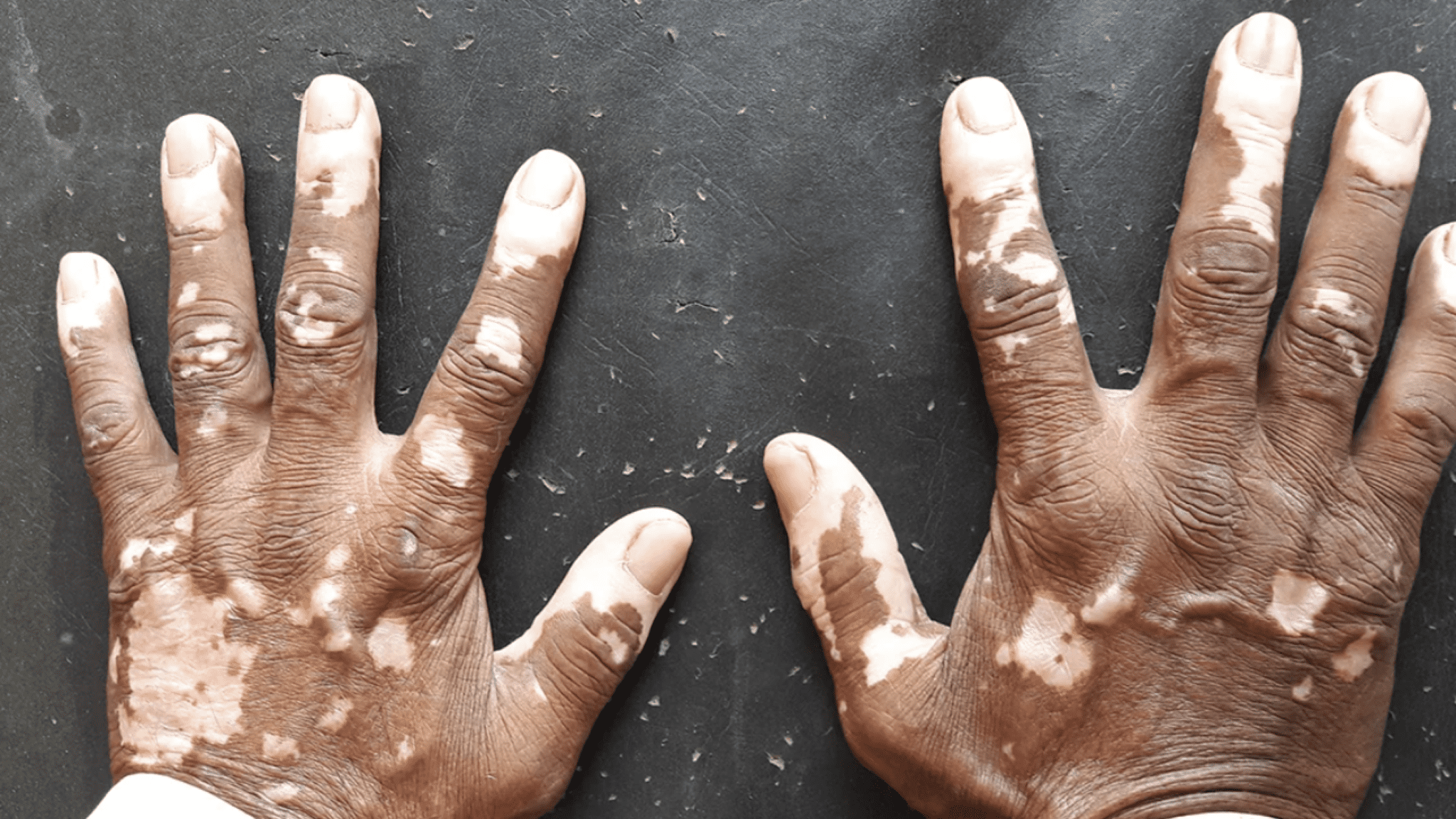 Understanding Common Skin Issues Affecting Black People - NOWINCLUDED